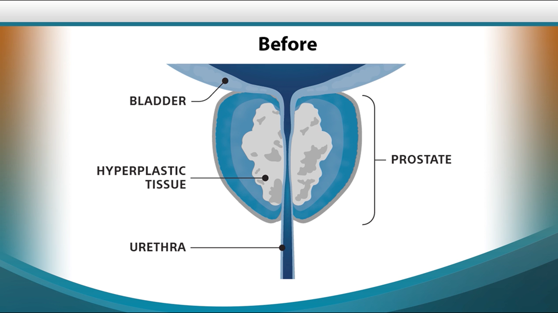 Frequent urination could be a sign of a condition that affects half of ...
