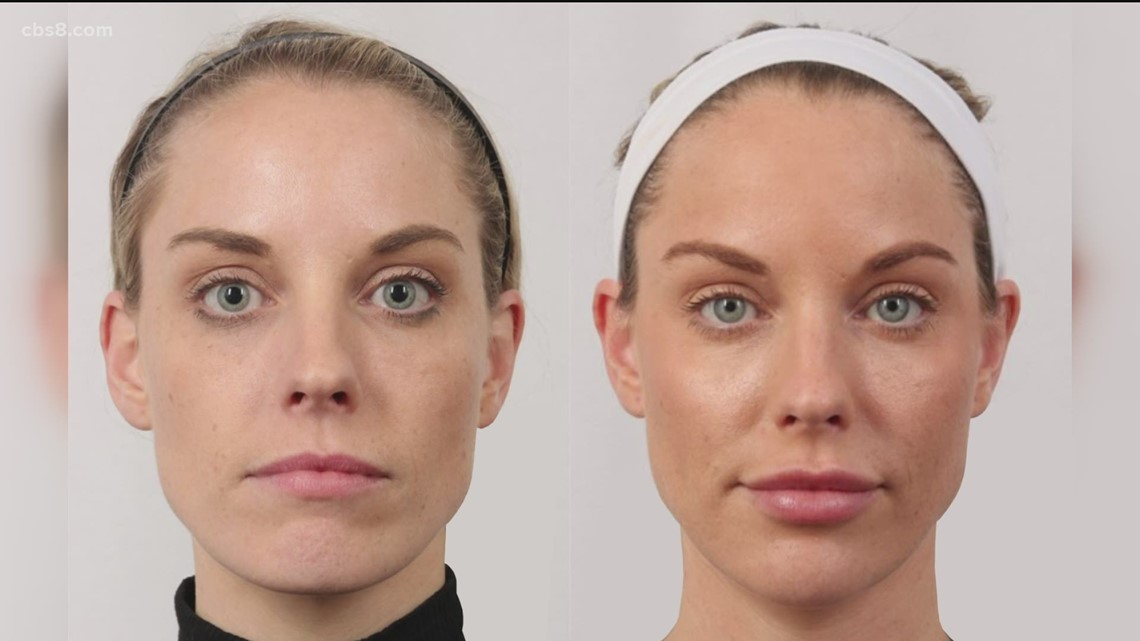 Zoom Face? Increase in demand for cosmetic procedures | cbs8.com