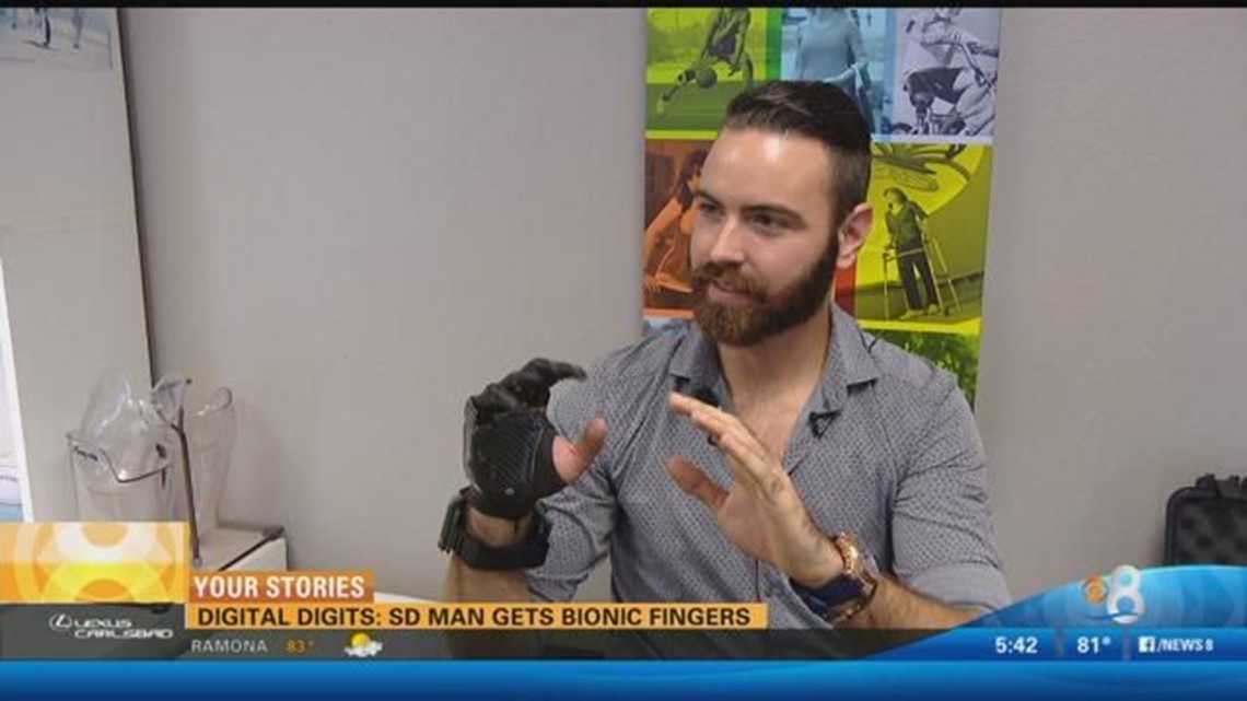 Digital Digits: San Diego man gets bionic fingers | cbs8.com