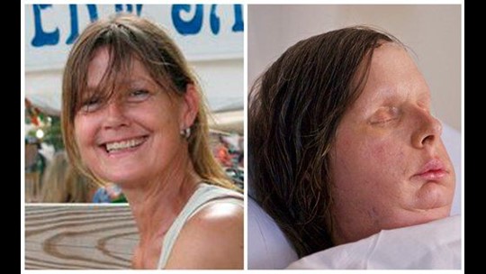 New face of chimpanzee attack victim revealed | cbs8.com