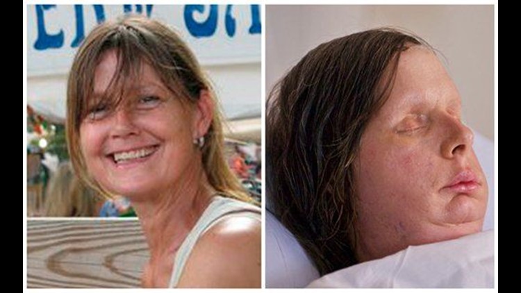 New face of chimpanzee attack victim revealed | cbs8.com