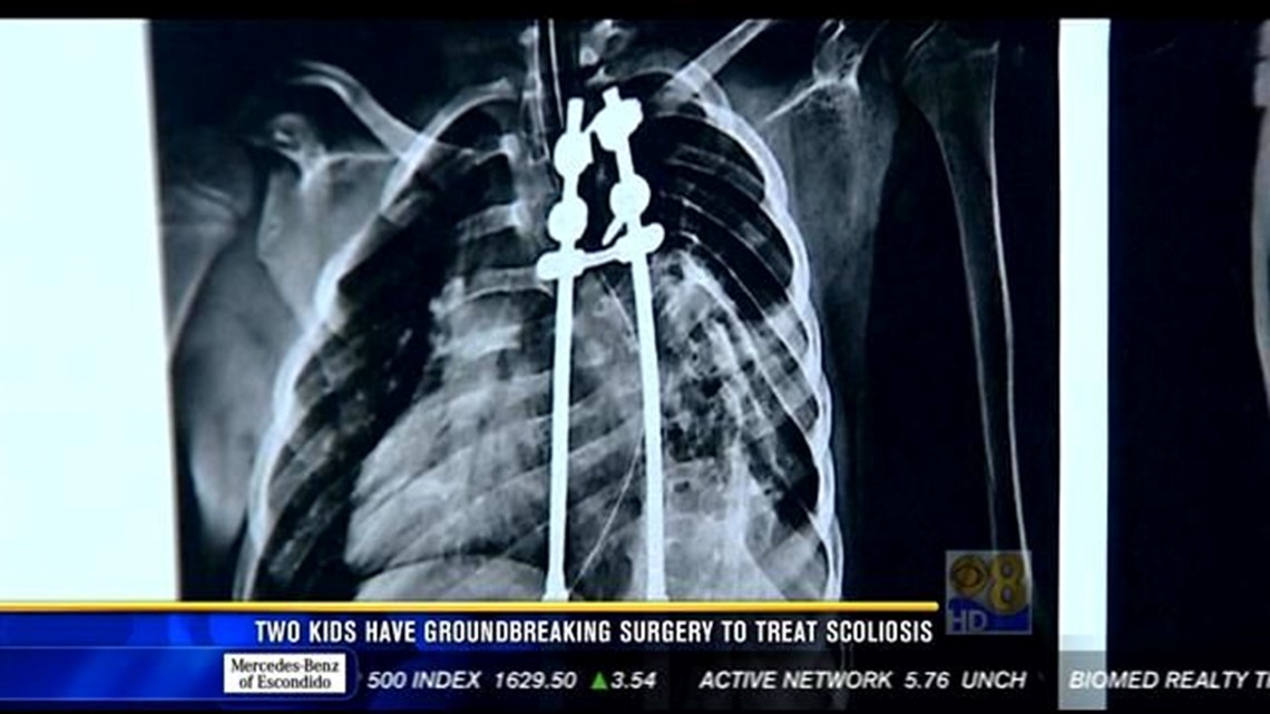 Two kids have groundbreaking surgery to treat scoliosis | cbs8.com