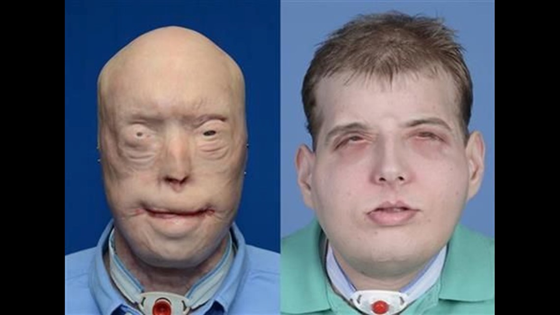 Transplant gives new face, scalp to burned firefighter | cbs8.com