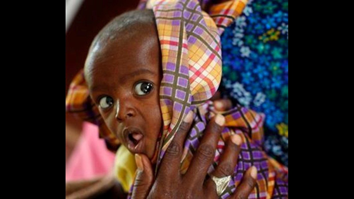 Malnourished Somali baby thriving as rare success | cbs8.com