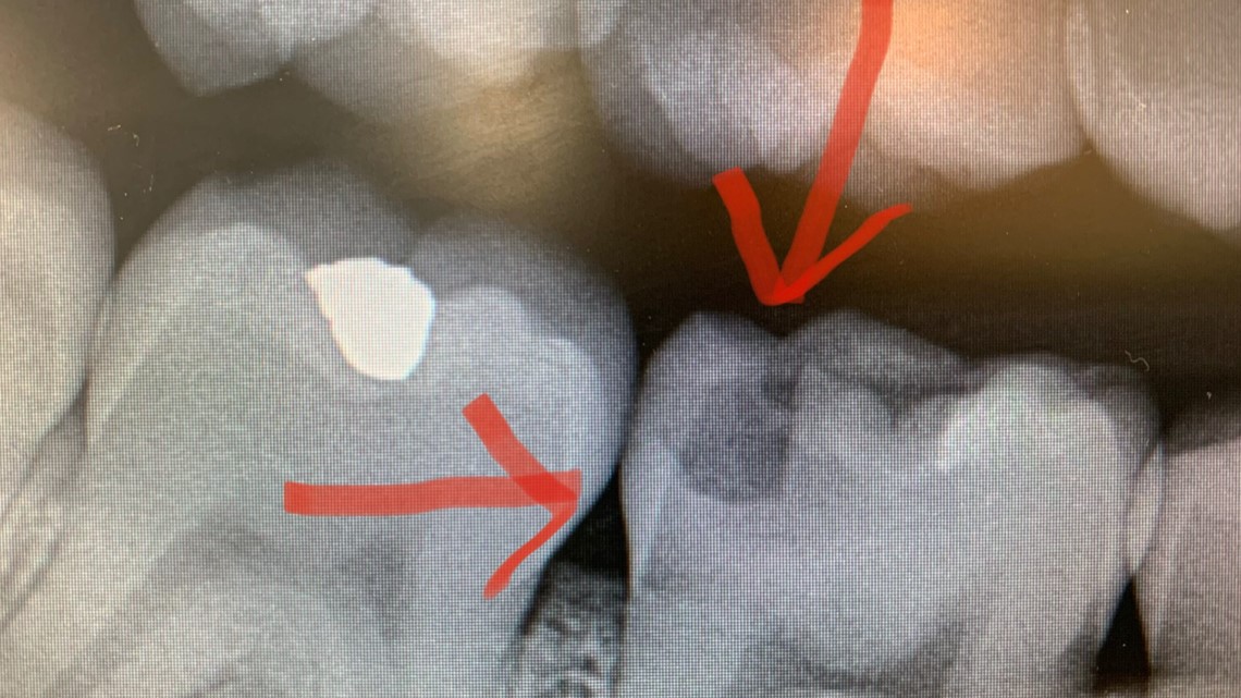 COVID crunch: Dentists say more people are grinding their teeth | cbs8.com