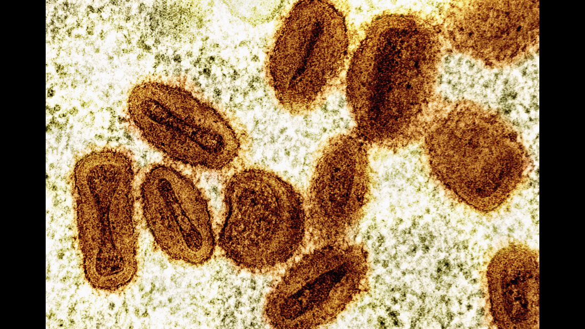 First case of new form of mpox found in United States | cbs8.com