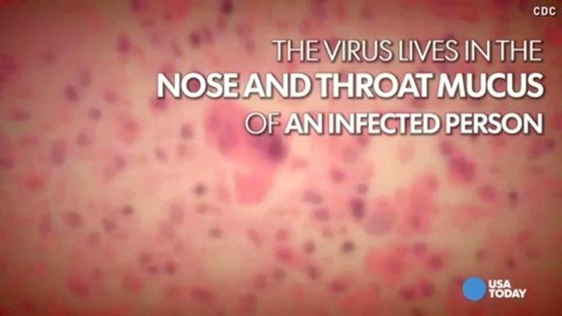 CDC monitoring increase in measles cases in 21 states, including ...