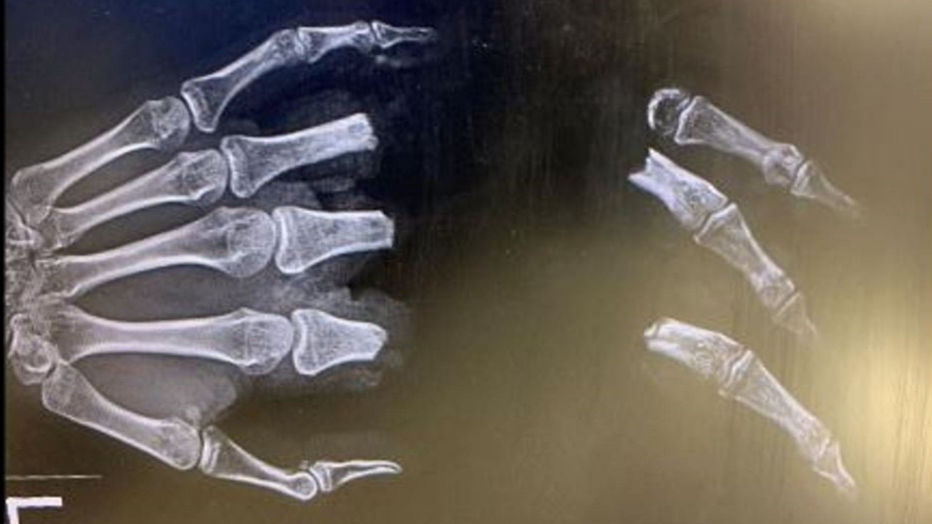 Teen sues Mission Bay Aquatic Center after losing fingers | cbs8.com