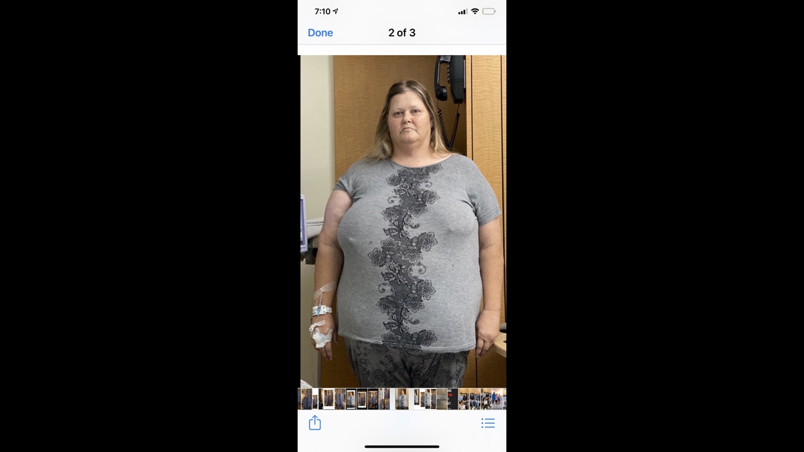 San Diego woman loses 231 pounds with gastric bypass | cbs8.com
