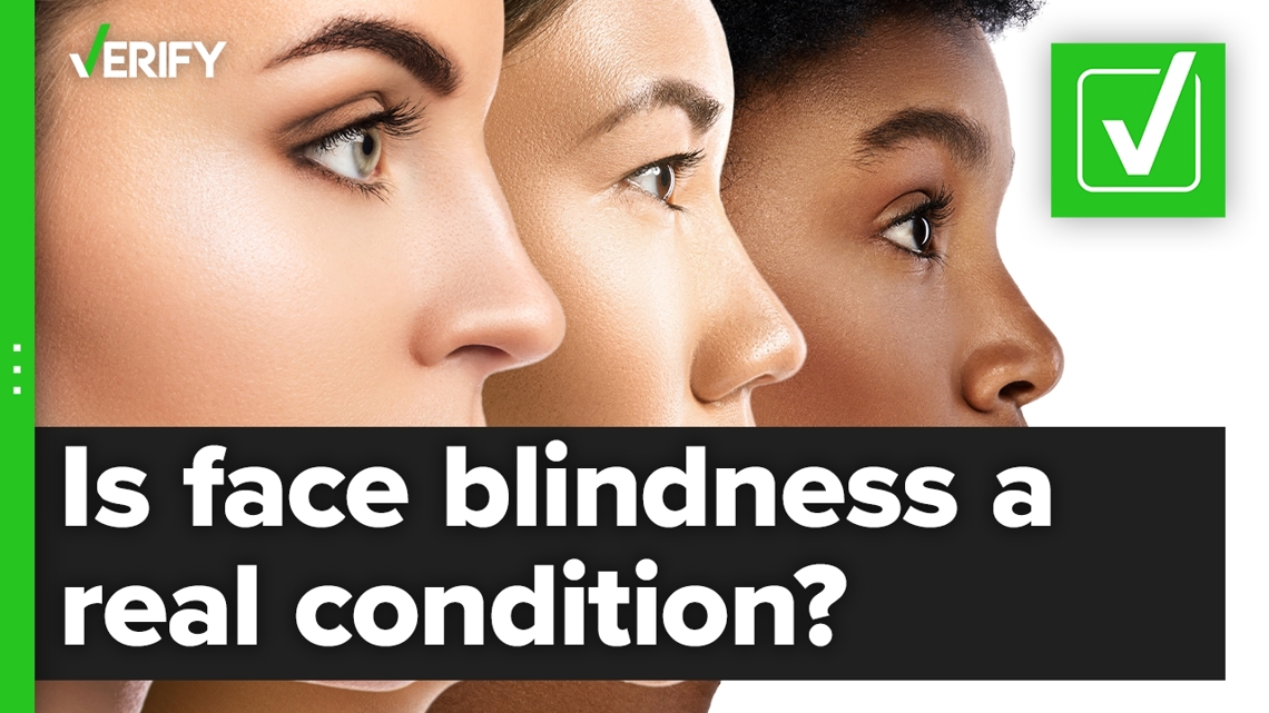 Yes, face blindness is a real condition | cbs8.com