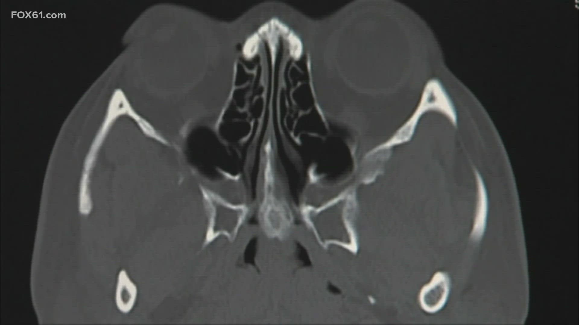 First Cte Diagnosis In Female Pro Athlete Announced